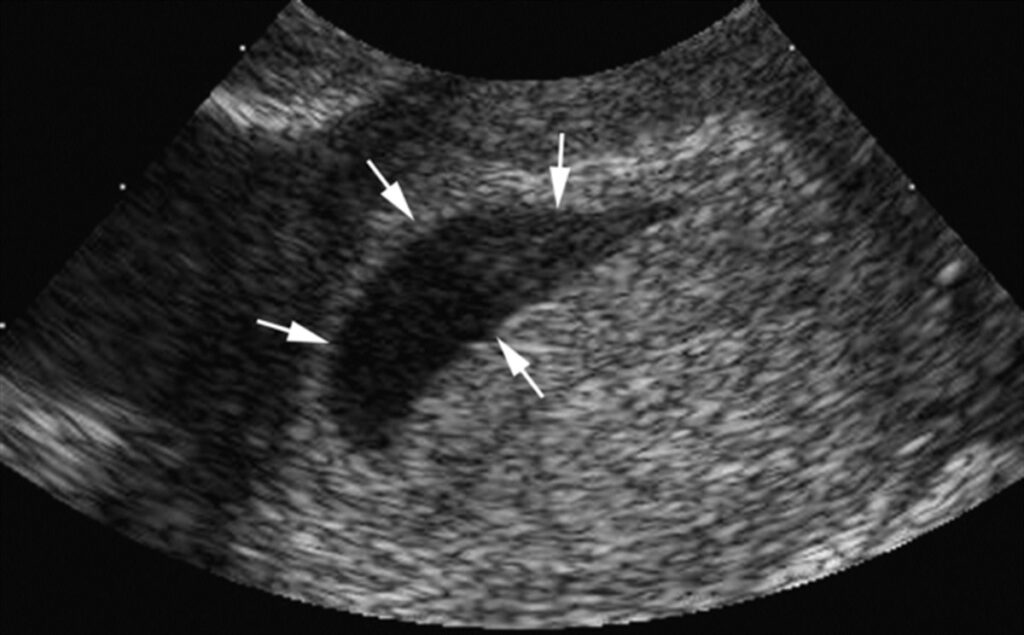 Polip Nedir? Endometrial Polip (Rahimde Polip) Nedir? – Doç. Dr. Selçuk ...